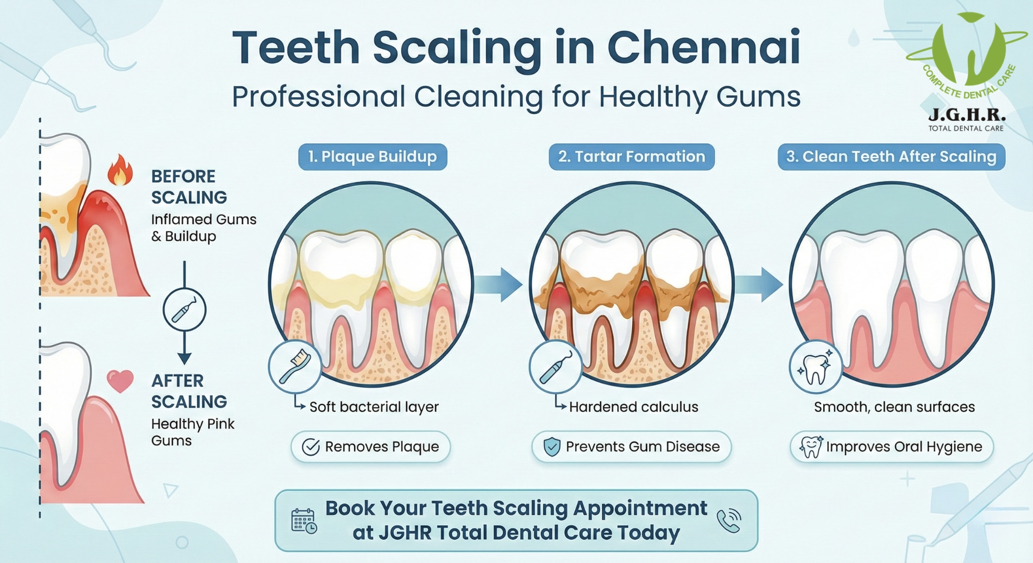 Teeth Scaling in Chennai: A Simple Guide for Patients - JGHR Total ...